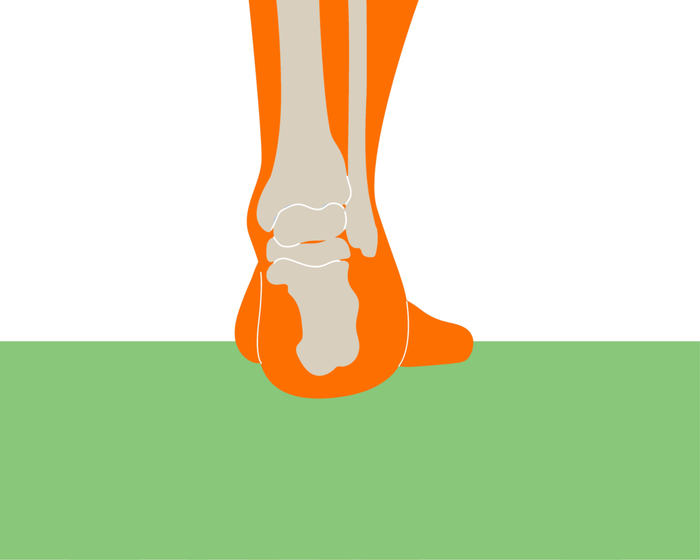 Best Shoes for Achilles Tendonitis | Managing Your Achilles Tendinitis